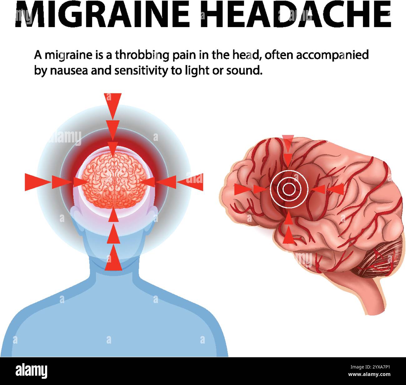 Illustration of migraine pain and brain anatomy Stock Vector Image & Art - Alamy