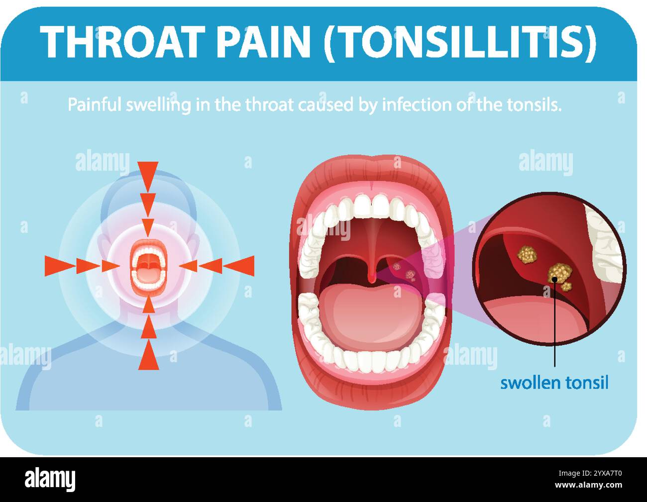 Illustration of tonsillitis symptoms and throat anatomy Stock Vector ...