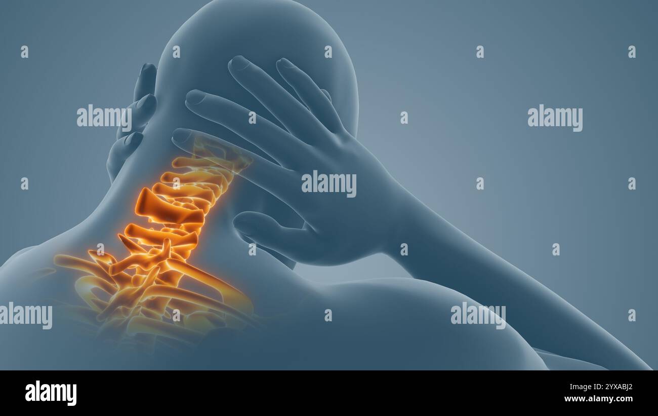 Cervical Syndrome Leading to Chronic Neck Discomfort Stock Photo - Alamy