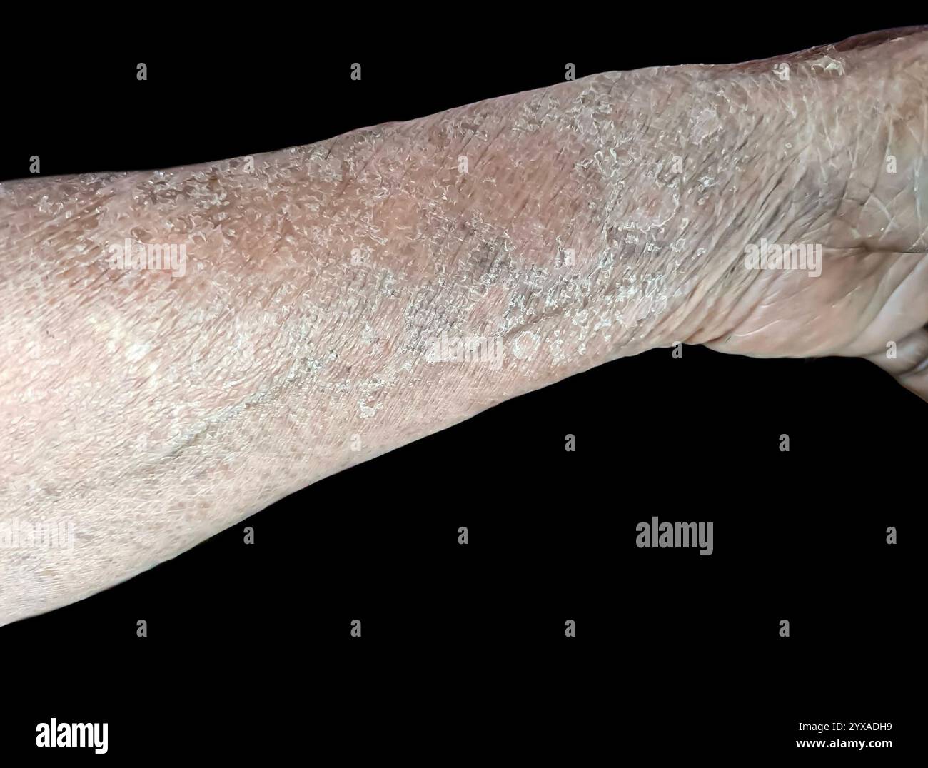 Pellagra, a skin condition caused by niacin deficiency, manifesting as ...