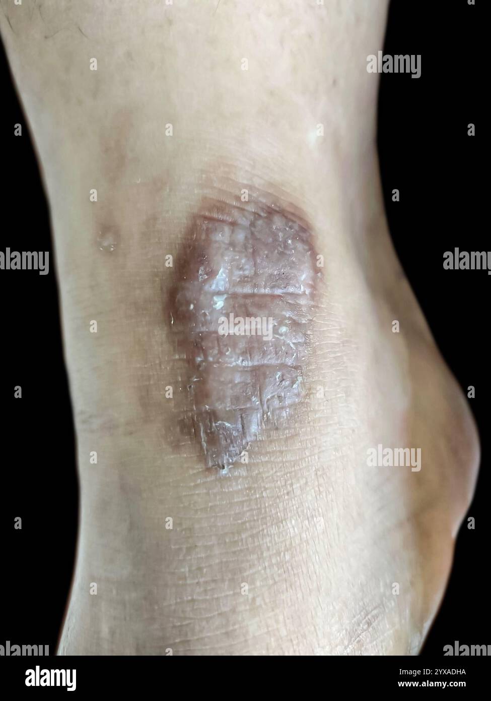 Epidermis surface with eczema dermatology hi-res stock photography and ...