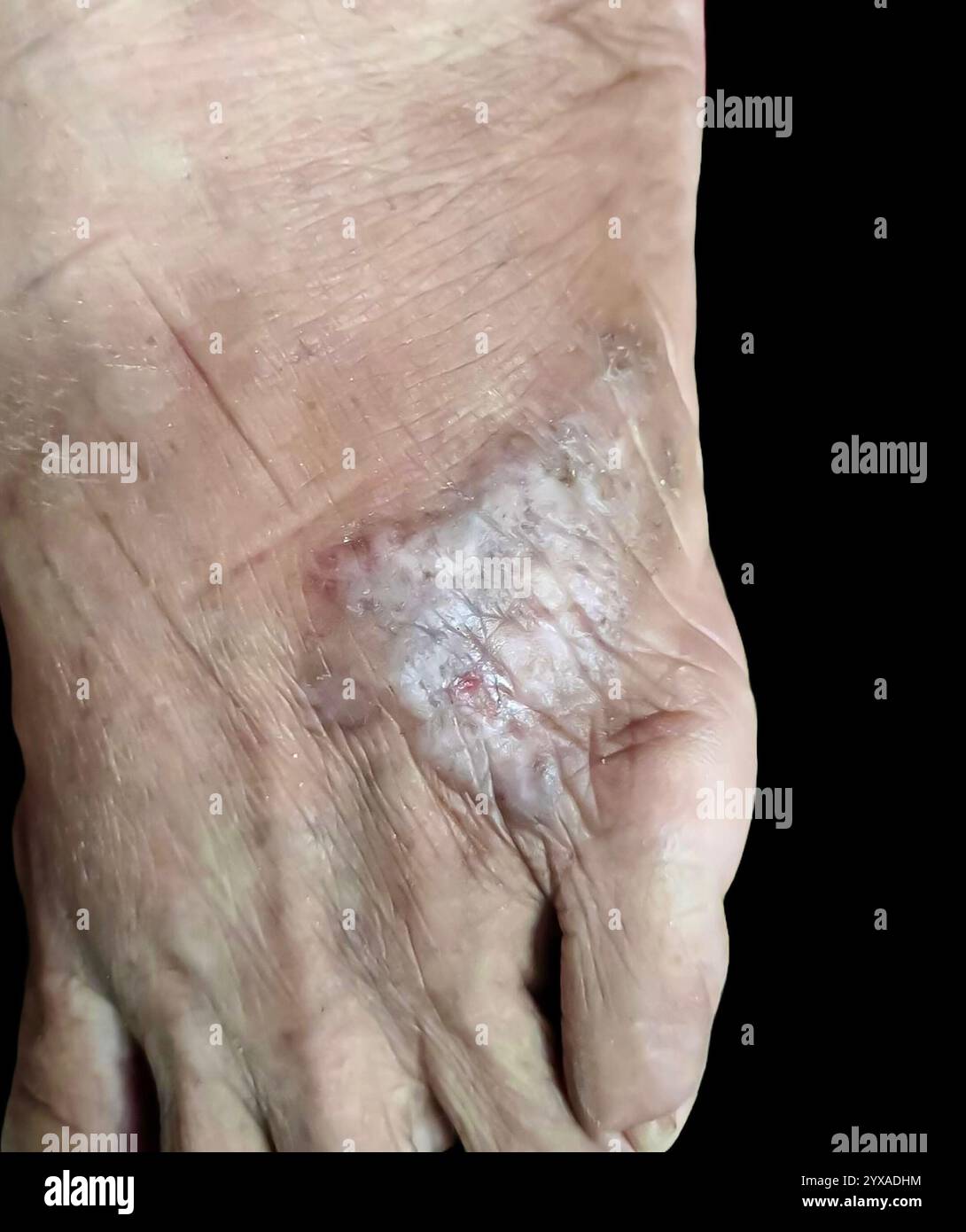 Closeup of an eczema patch with discoloration on the surface of human ...