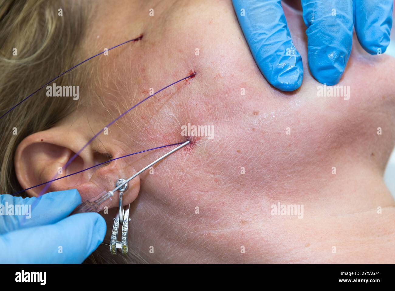 Close-up anti-age facial lifting procedure using PDO threads of ...