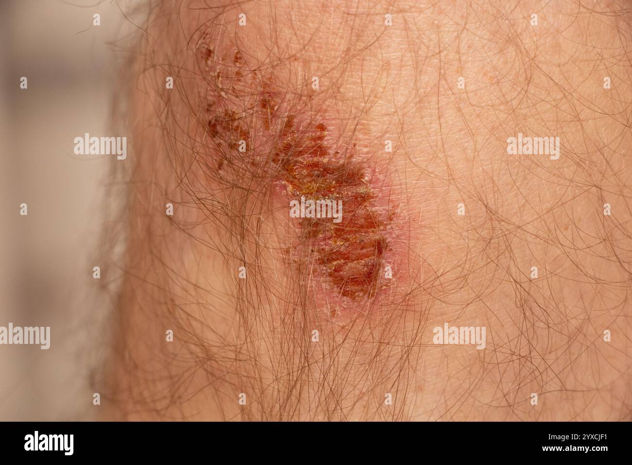 Bruise after a fall hi-res stock photography and images - Alamy