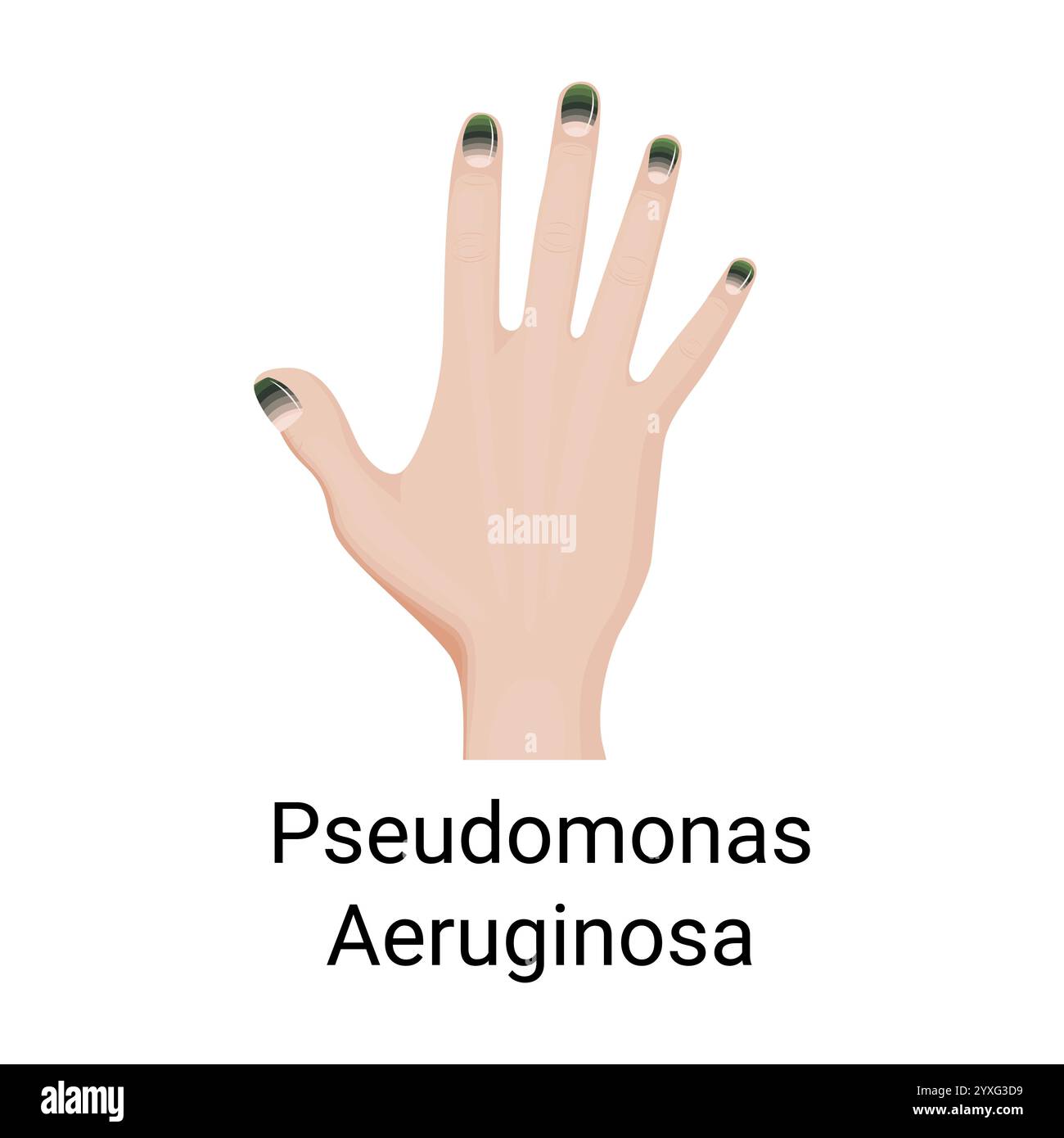 Green Nail Syndrome, fingernail chloronychia symptom Stock Vector Image ...