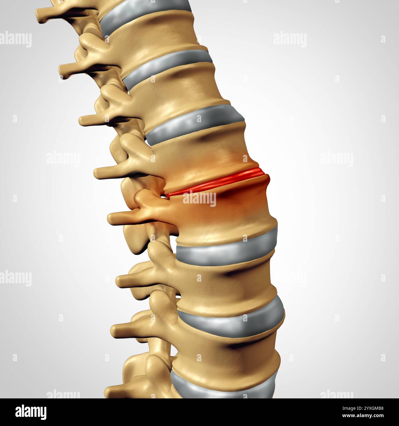 Thinning Spinal Disc degeneration as a degenerative Spinal Disorder as ...