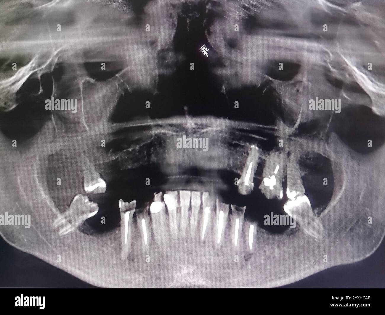 Image of a panoramic x-ray of teeth with coarse edentia Stock Photo - Alamy