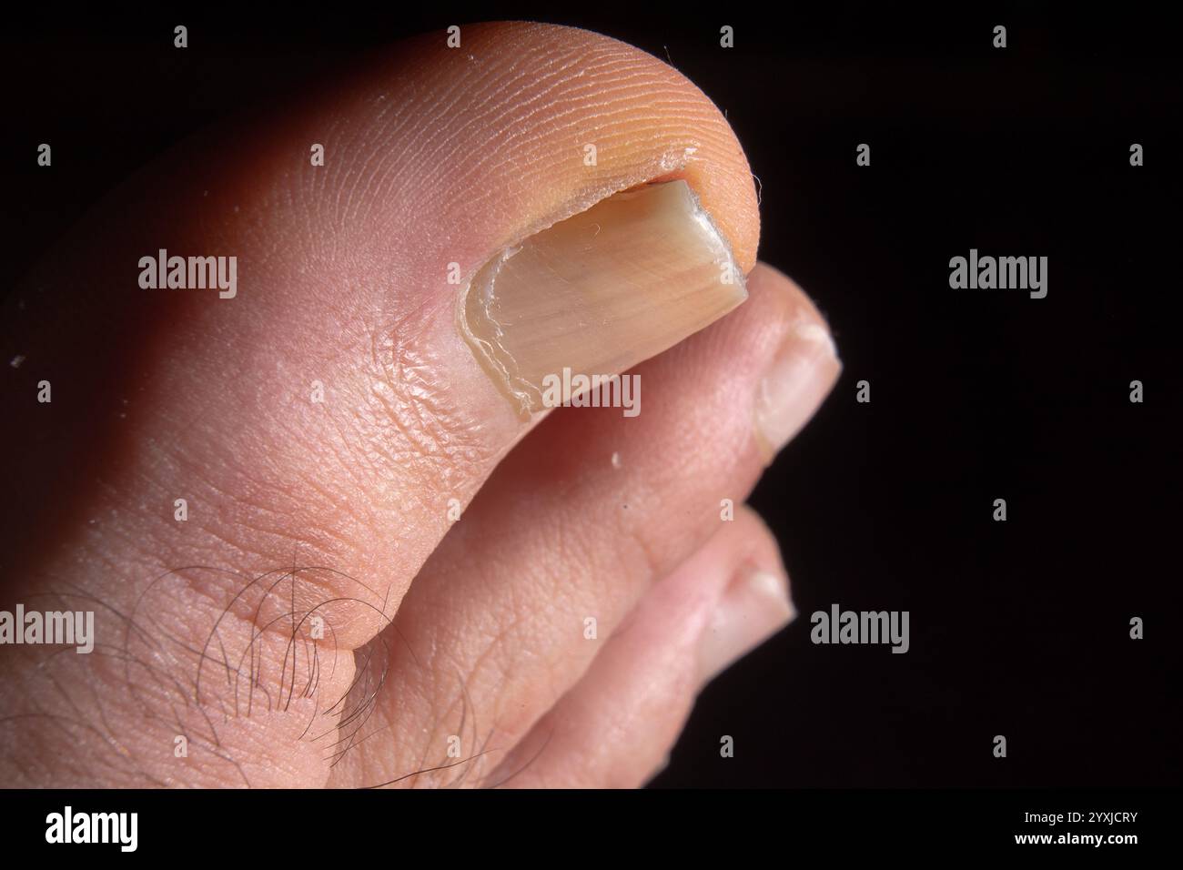 Three human toes with illumination on the right side under black ...