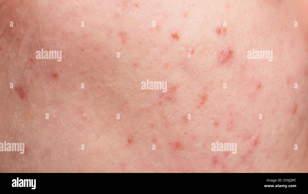 Many pimples. Bad skin. Hormonal acne, puberty. Skin acne background ...