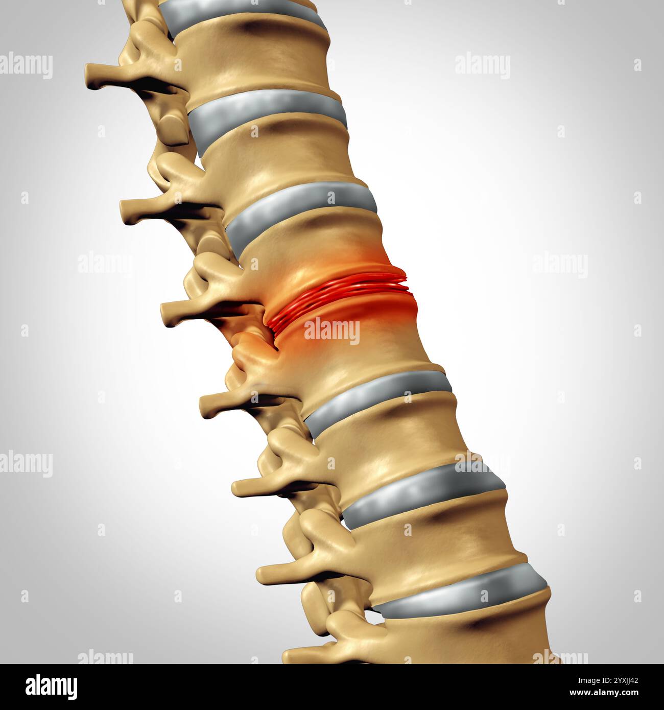Degenerative disc spine disorders back pain concept due to wear and ...