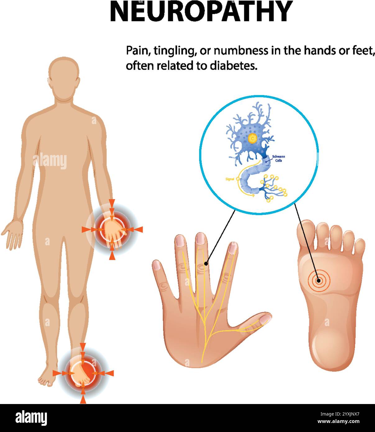 Illustration of neuropathy symptoms in hands and feet Stock Vector Image & Art - Alamy