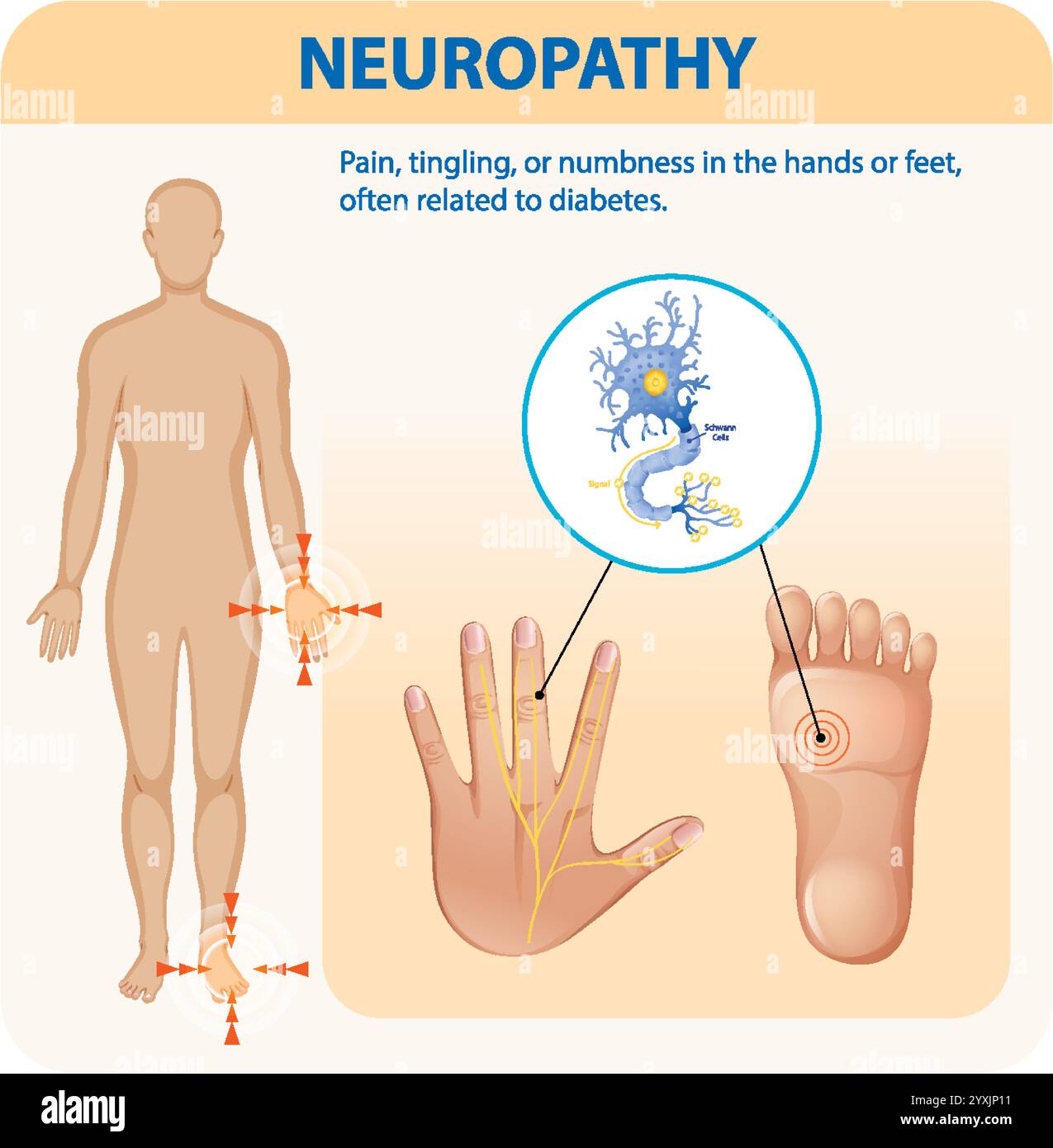 Peripheral neuropathy of the feet hi-res stock photography and images - Alamy