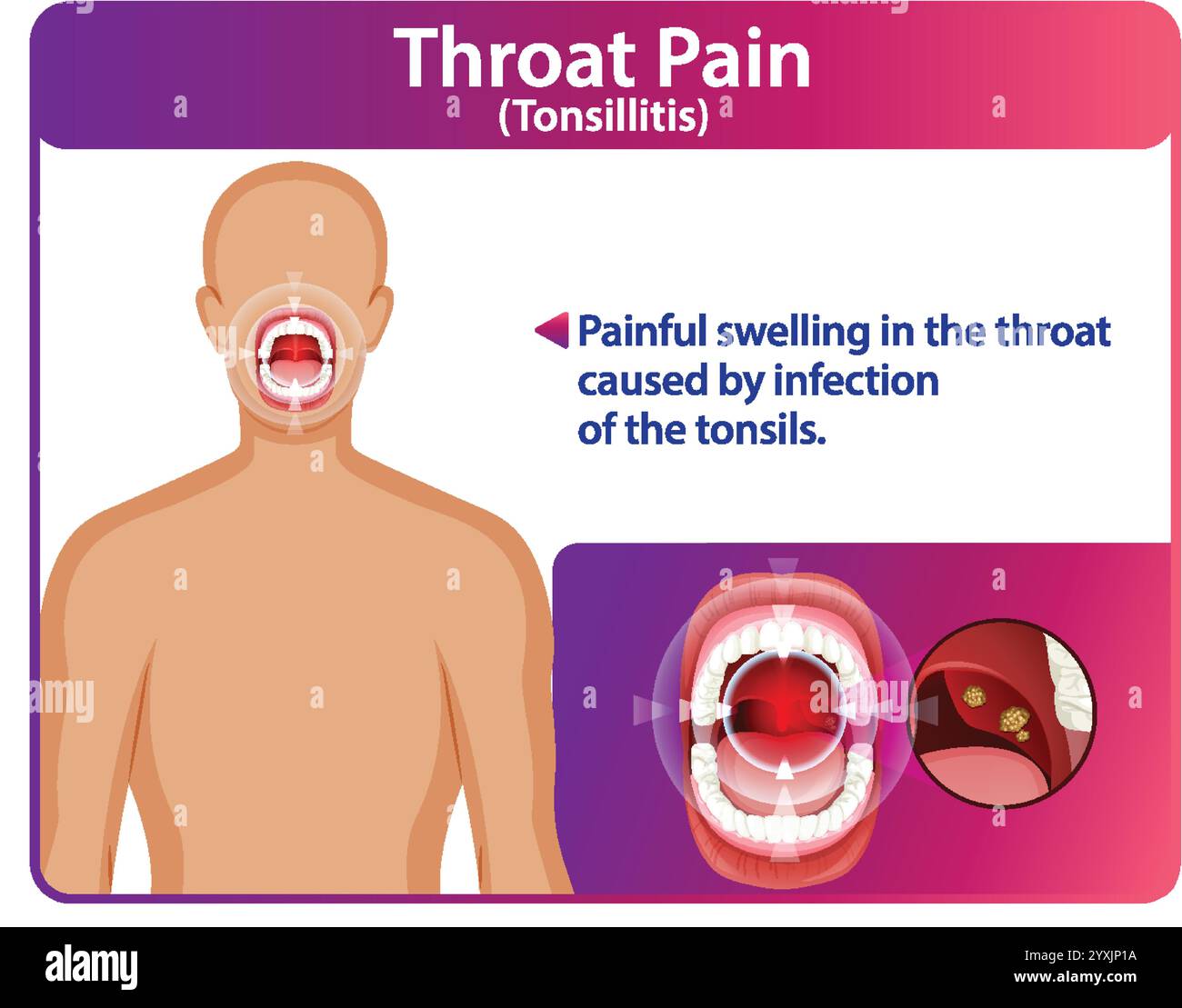 Illustration of throat pain caused by tonsillitis Stock Vector Image ...