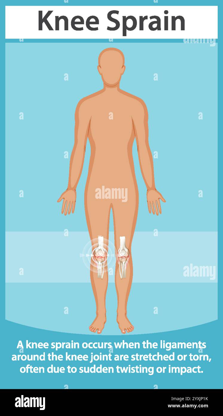 Illustration of knee sprain with highlighted ligaments Stock Vector ...