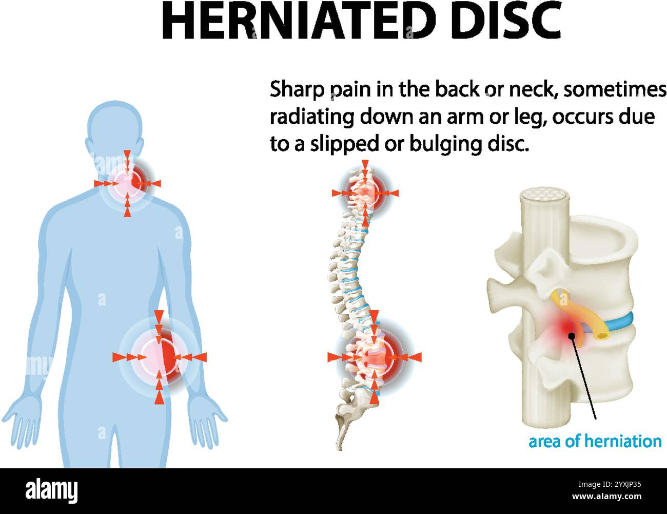 Herniated disc sciatica Cut Out Stock Images & Pictures - Alamy