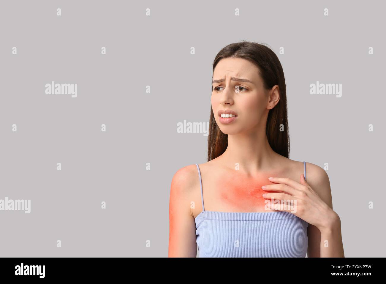 Young woman with red sunburned skin on grey background Stock Photo - Alamy