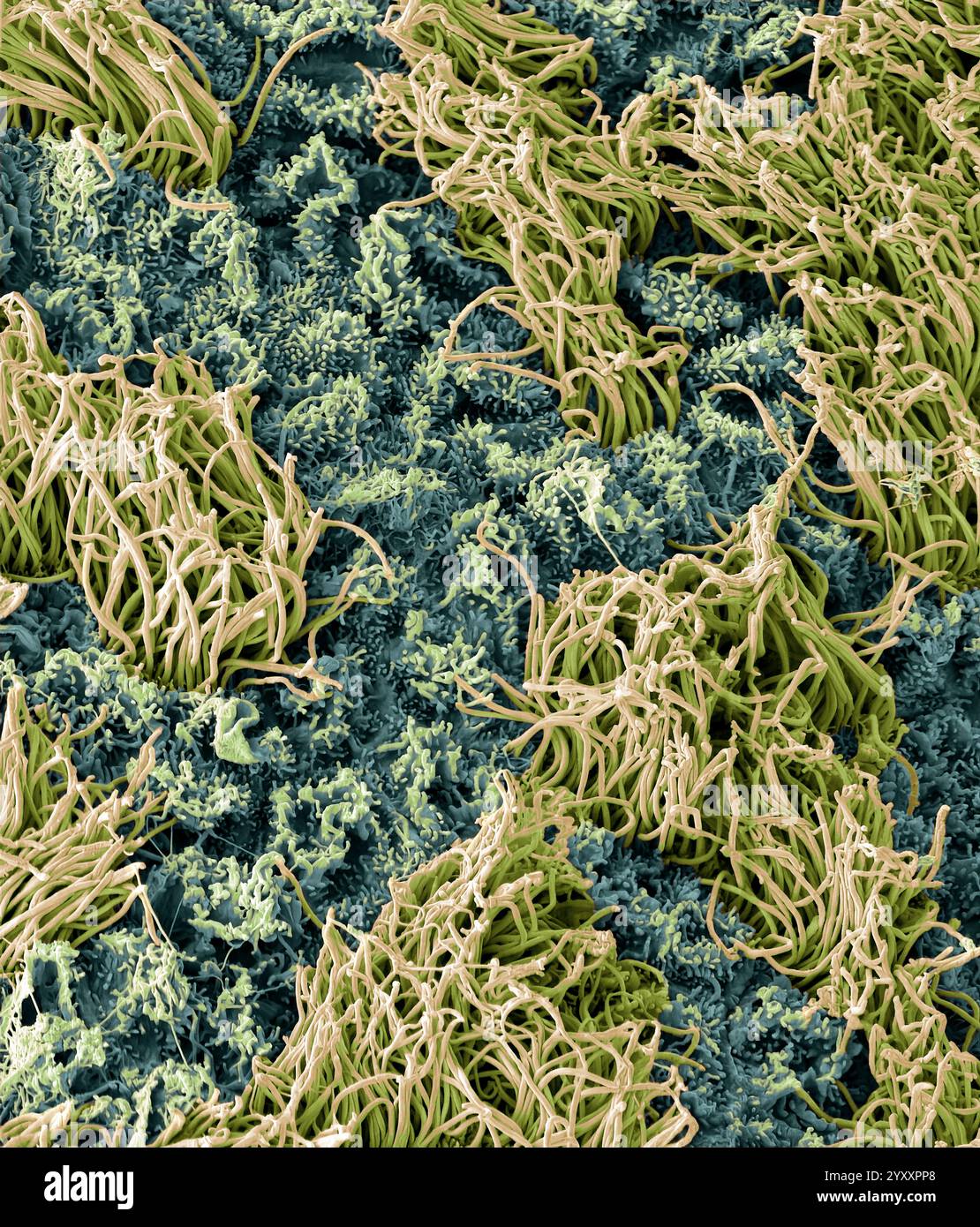 Uterine cancer. Coloured scanning electron micrograph (SEM) of ...