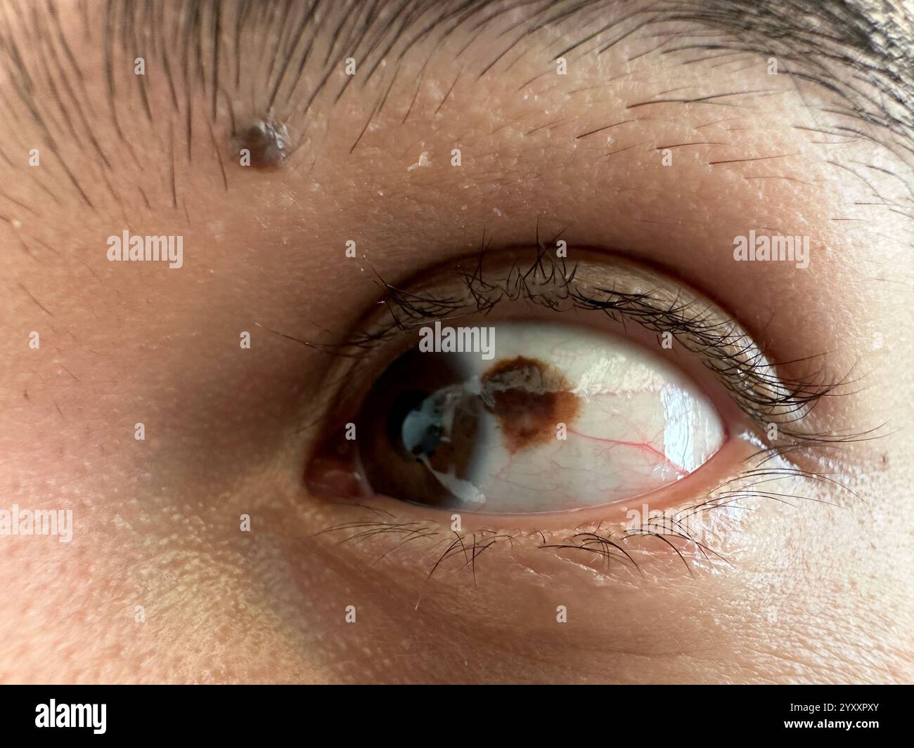 Eye of a patient with a benign (non-cancerous) naevus of the ...