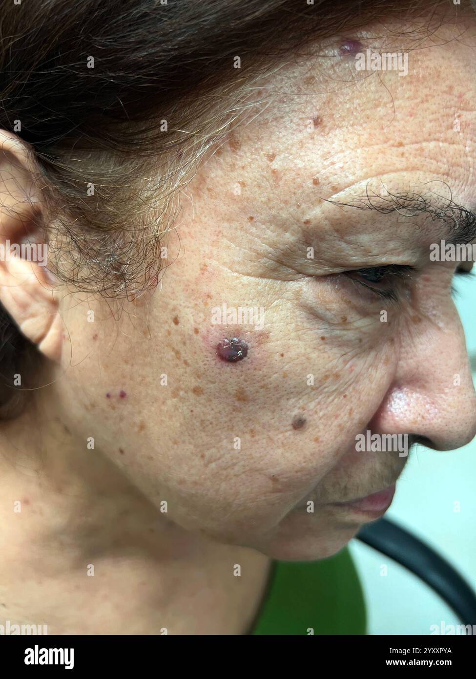 Basal cell carcinoma (BCC), or rodent ulcer, on the cheek of a Hispanic ...