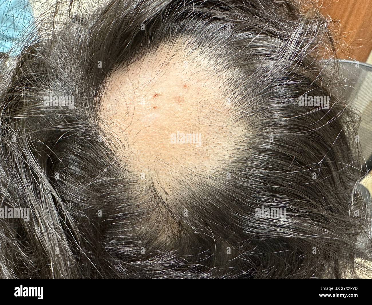 Bald spot on the scalp of a patient with alopecia areata (spot baldness ...