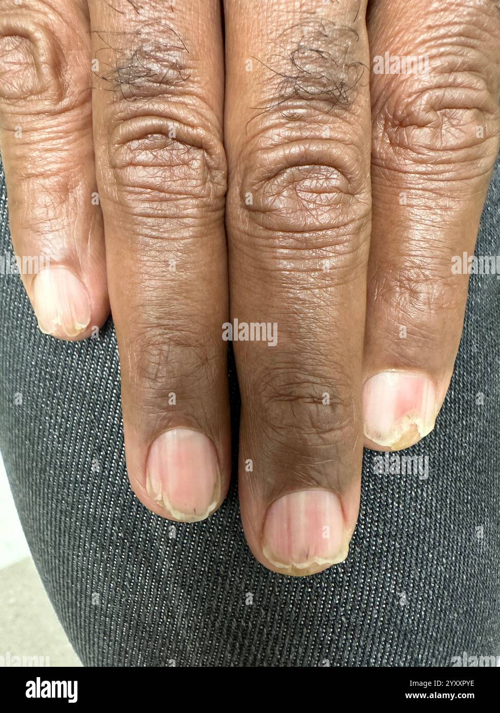 Papules on the fingers of an African American male patient with Darier ...