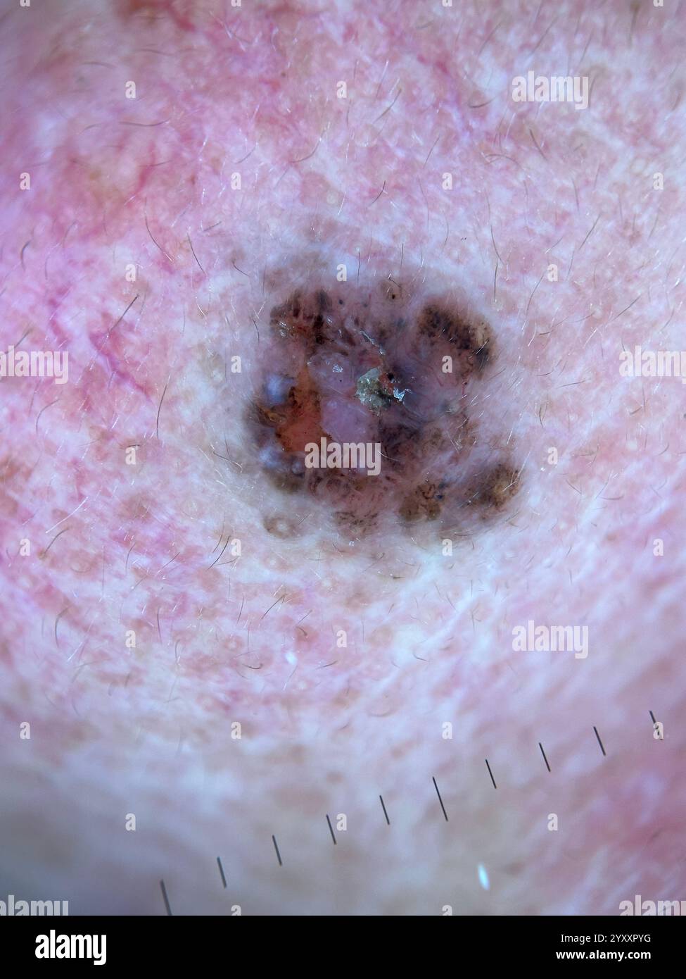 Dermatoscope image of a pigmented basal cell carcinoma (BCC), or rodent ...