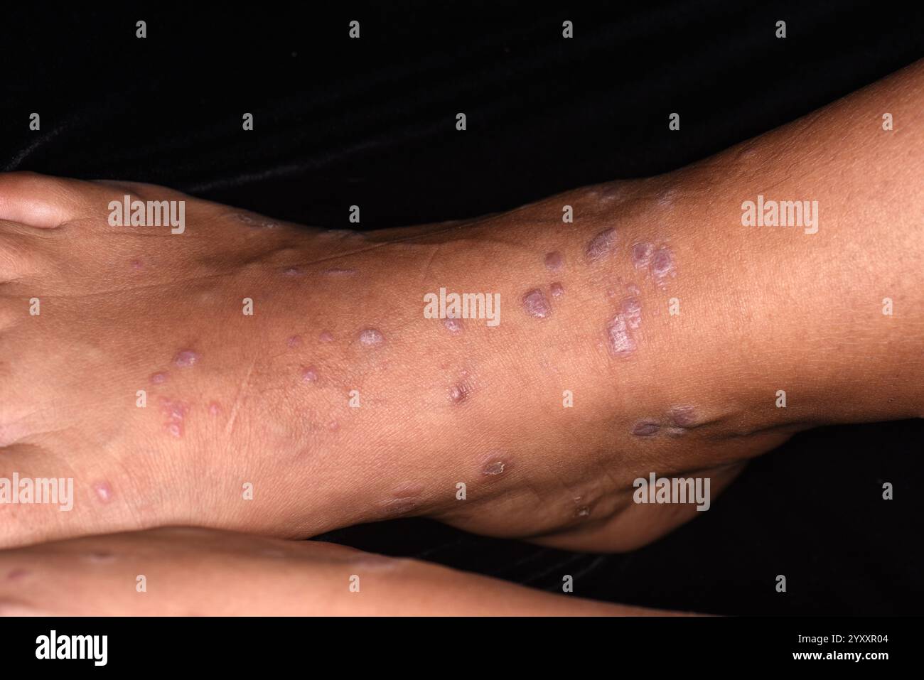 Lichen planus on the ankle of a 41 year old Hispanic female patient ...