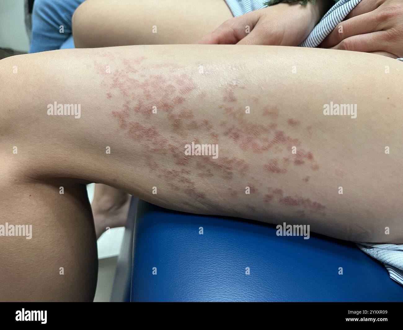 Lichen planus on a woman's thigh. Lichen planus is an inflammatory ...