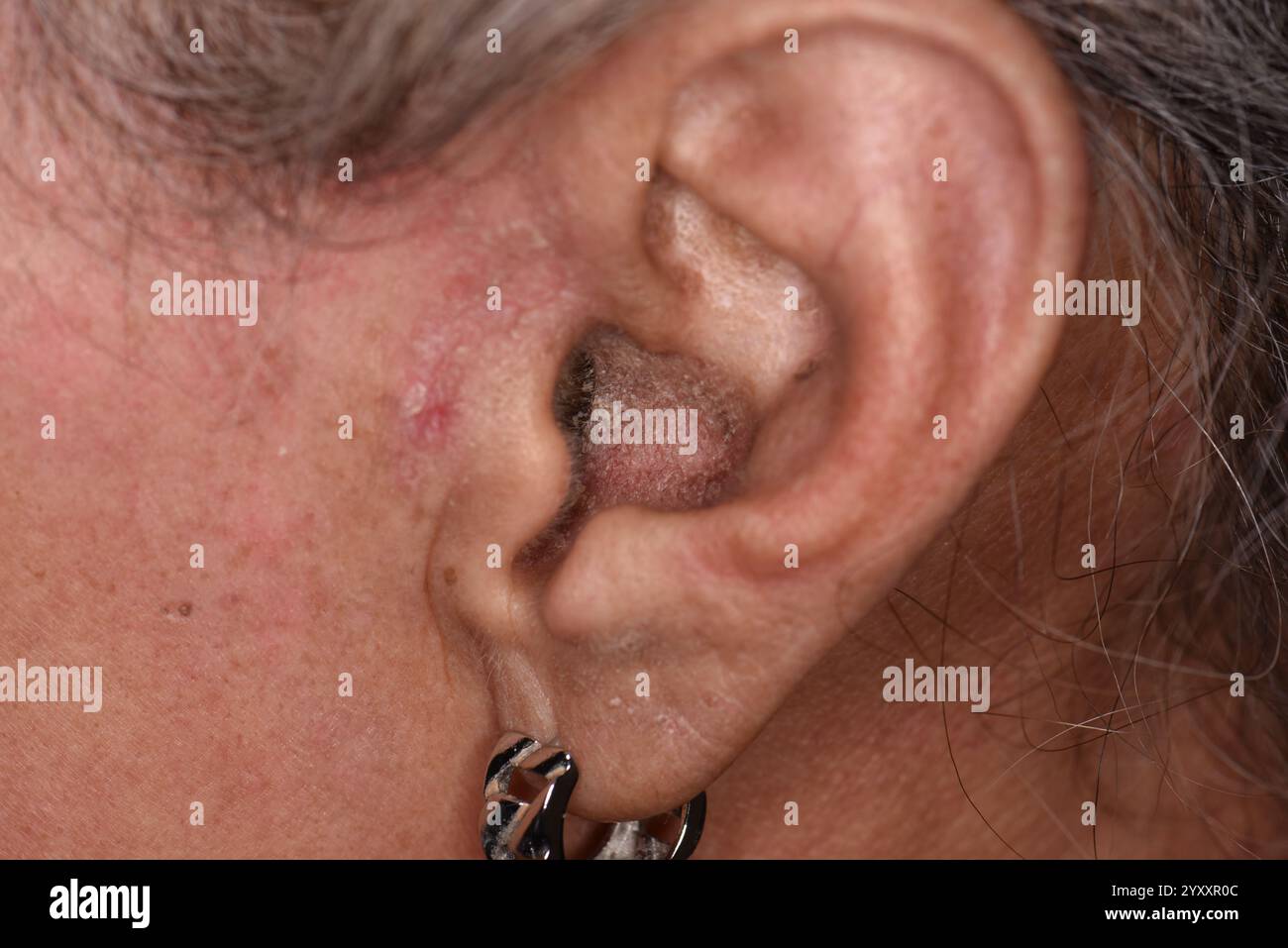 Lesions on the ear of a patient with discoid lupus erythematosus (DLE ...