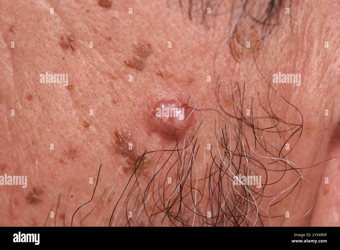 Nodular basal cell carcinoma (BCC), or rodent ulcer, on a 66 year old ...