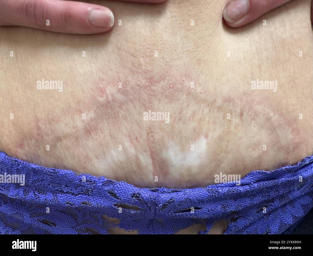 Pyoderma gangrenosum lesions on the abdomen of a patient who is being ...