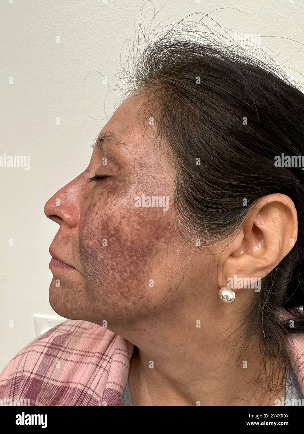 Face of a female patient with lichen planus pigmentosus. This is a rare ...