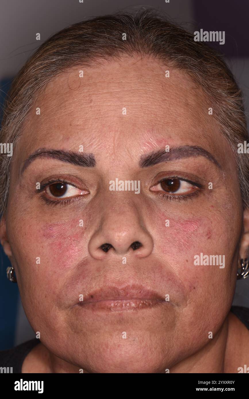 Lesions on the face of a patient with discoid lupus erythematosus (DLE ...