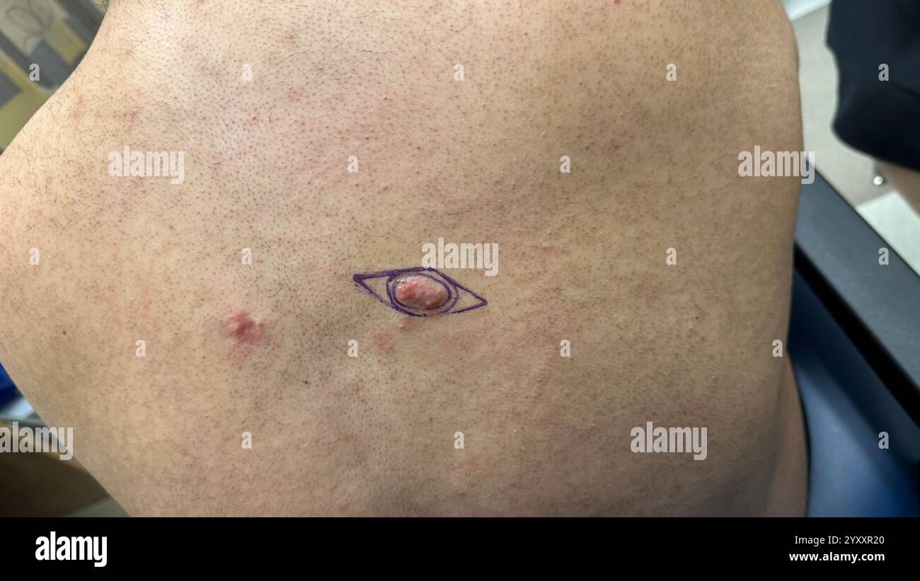 Lesion on the back of a Hispanic male patient with cutaneous B-cell ...