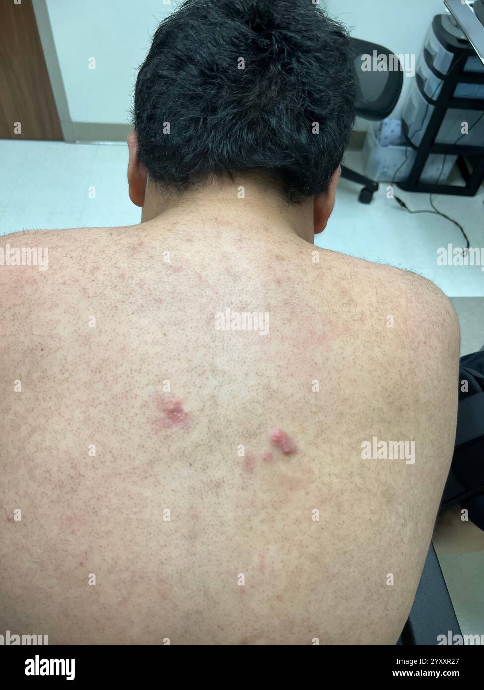Lesions on the back of a Hispanic male patient with cutaneous B-cell ...