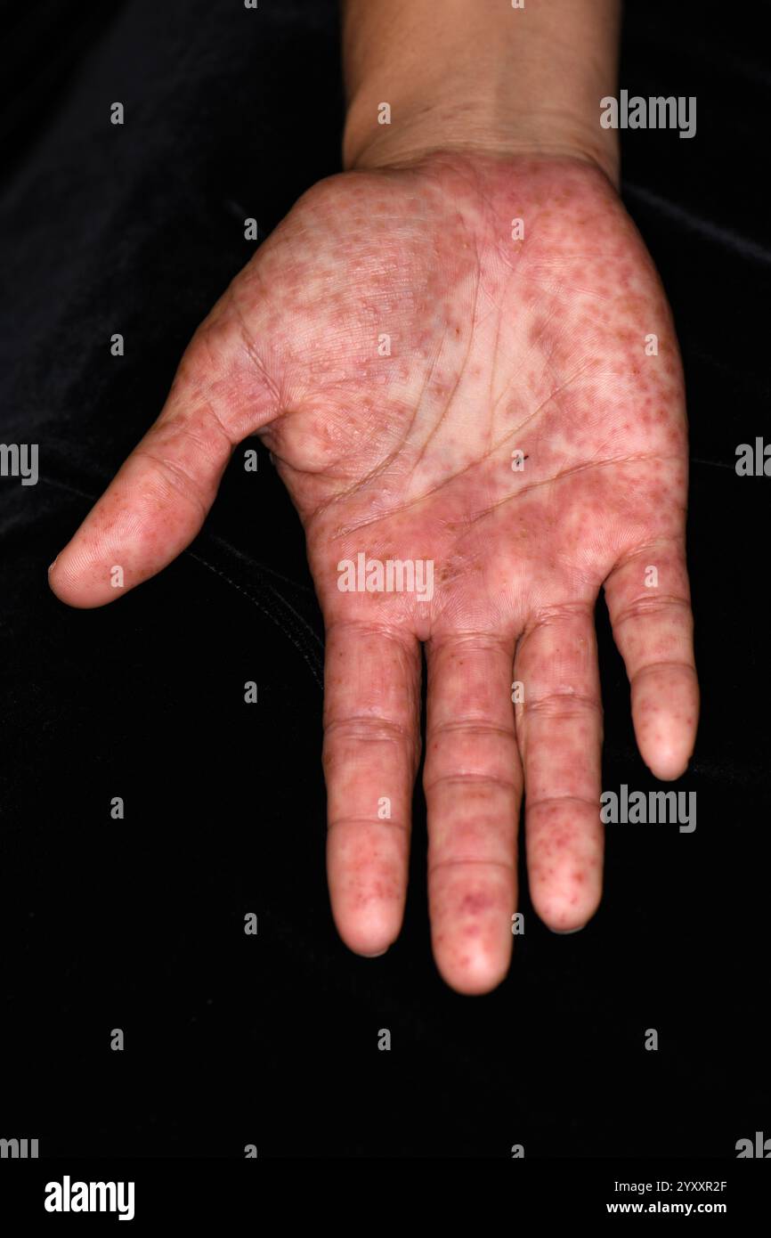 Rash on a 29 year old Hispanic female patient's hand in reaction to a ...