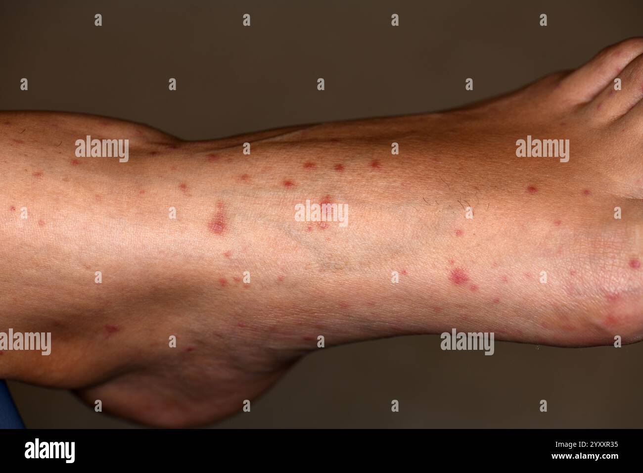 Rash on a 29 year old Hispanic female patient's foot in reaction to a ...