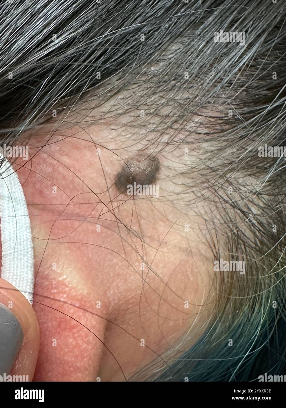 Mole behind the ear of a 19 year old female Hispanic patient. This skin ...