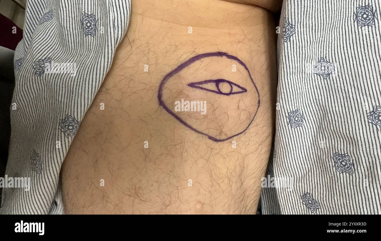 Large lipoma marked for excision on the leg of a white female patient ...