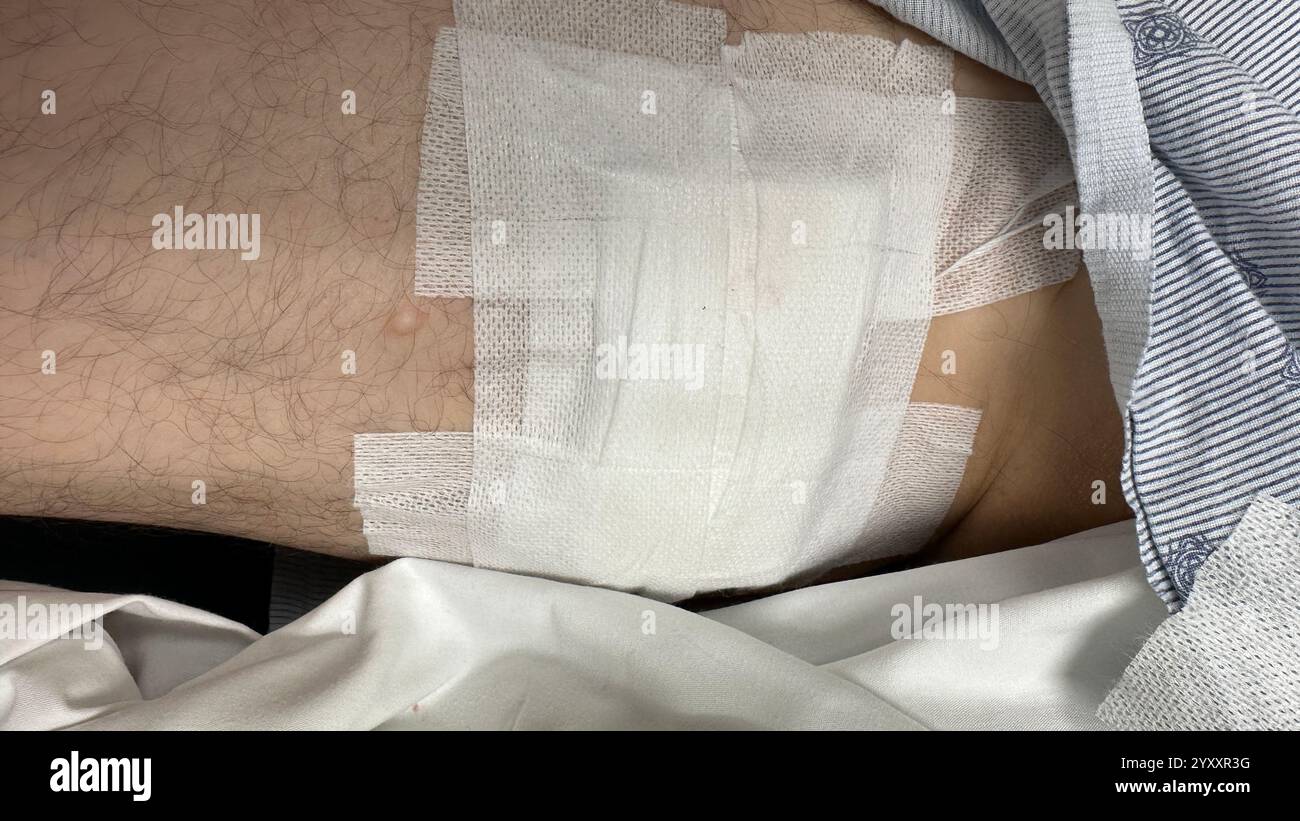 Dressing on the leg of a white female patient after the excision of a ...