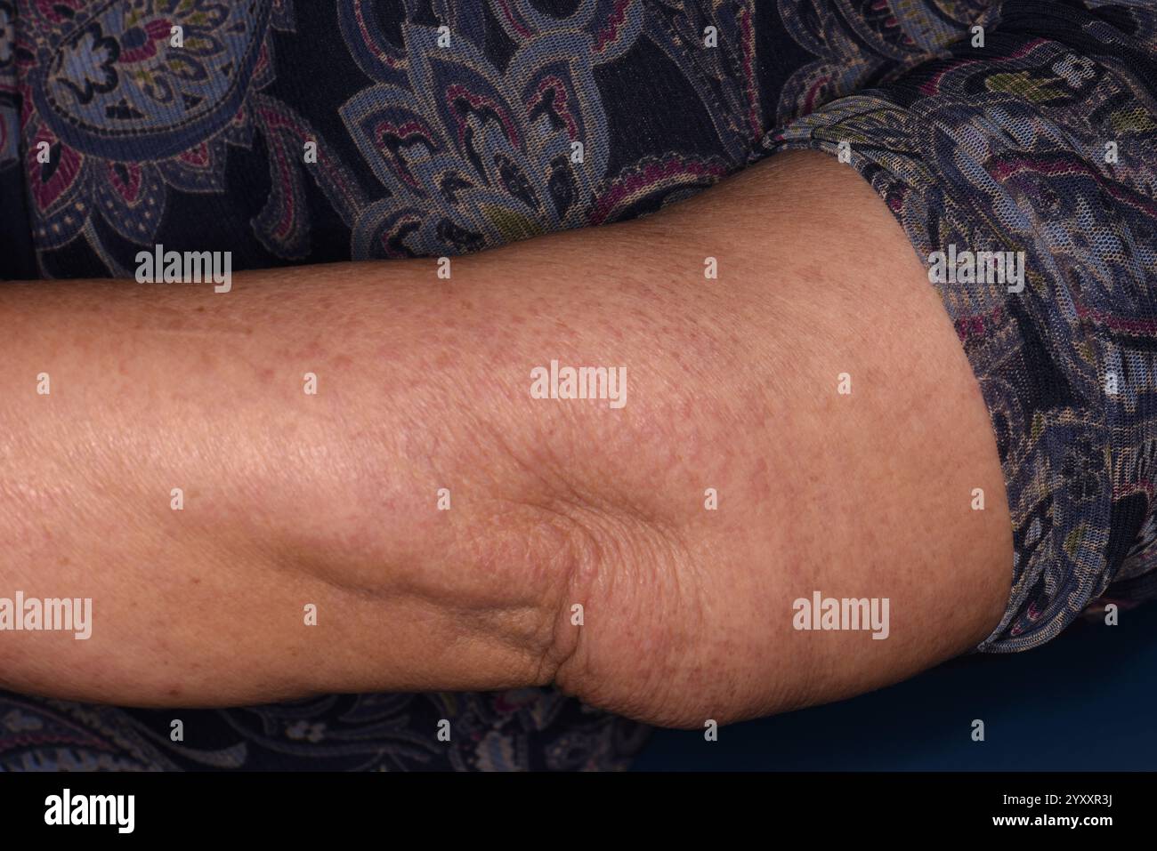 Rash on the arm of a 72 year old female Hispanic patient with ...