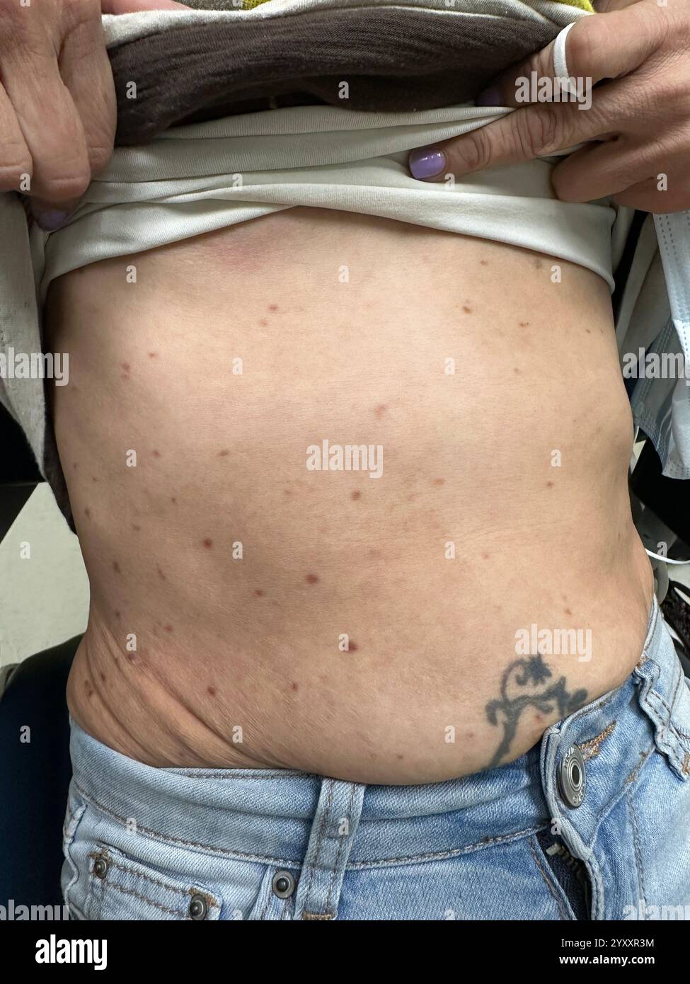 Rash on the abdomen of a patient with lymphoma. Lymphomas are blood ...