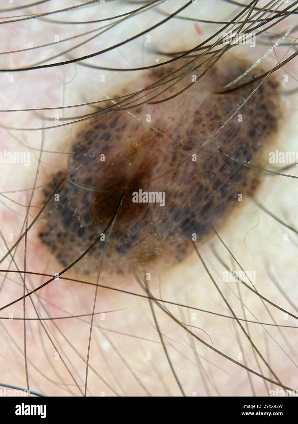 Dermatoscope image of a mole behind the ear of a 19 year old female ...