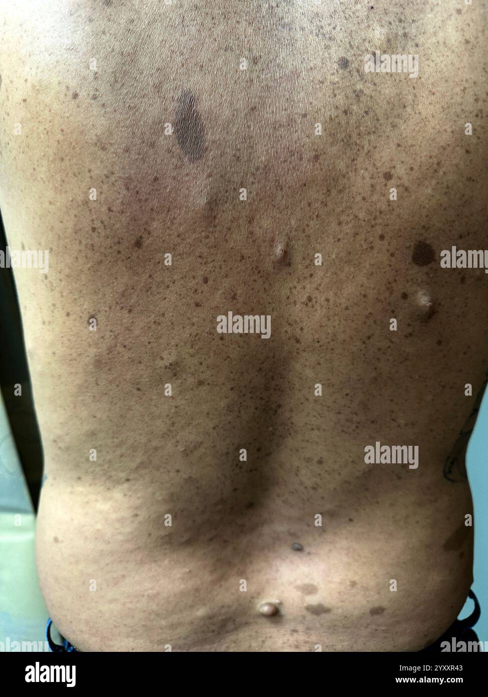 Recklinghausen's disease. Cafe au lait patches and nodules on the back ...