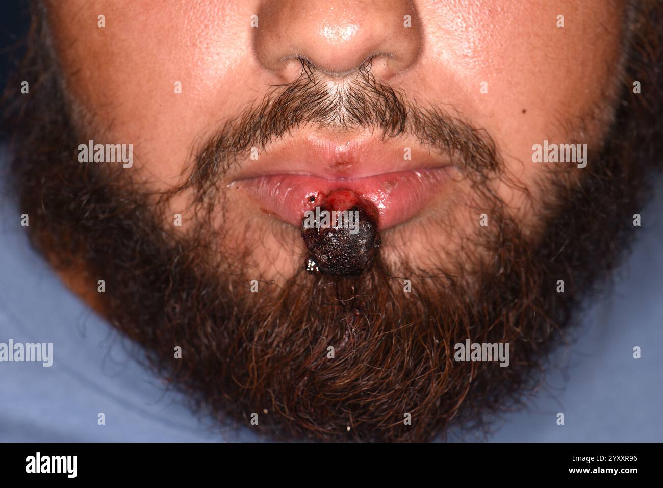 Editorial use only Pyogenic granuloma on a 25 year old Hispanic male ...