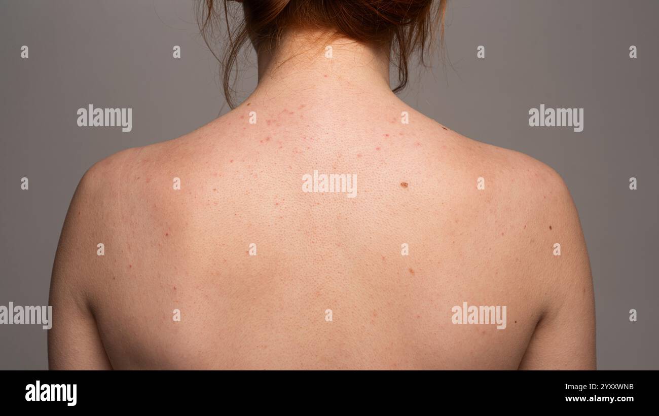 Acne skin. Skin acne background. Acne problem on back. Dermatology and ...