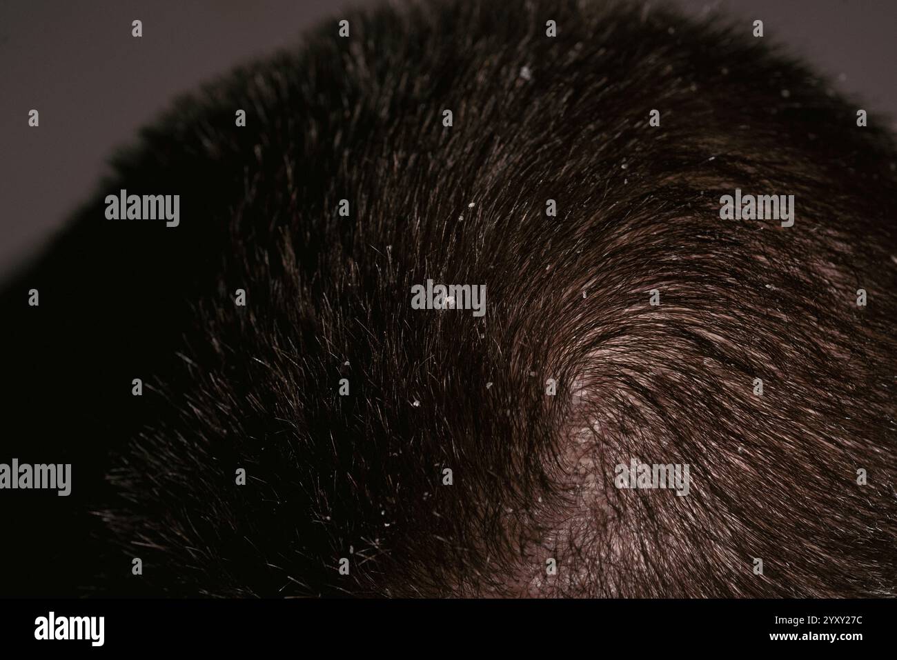 Hair with dandruff. Scalp problem, dandruff and dermatitis or eczema ...