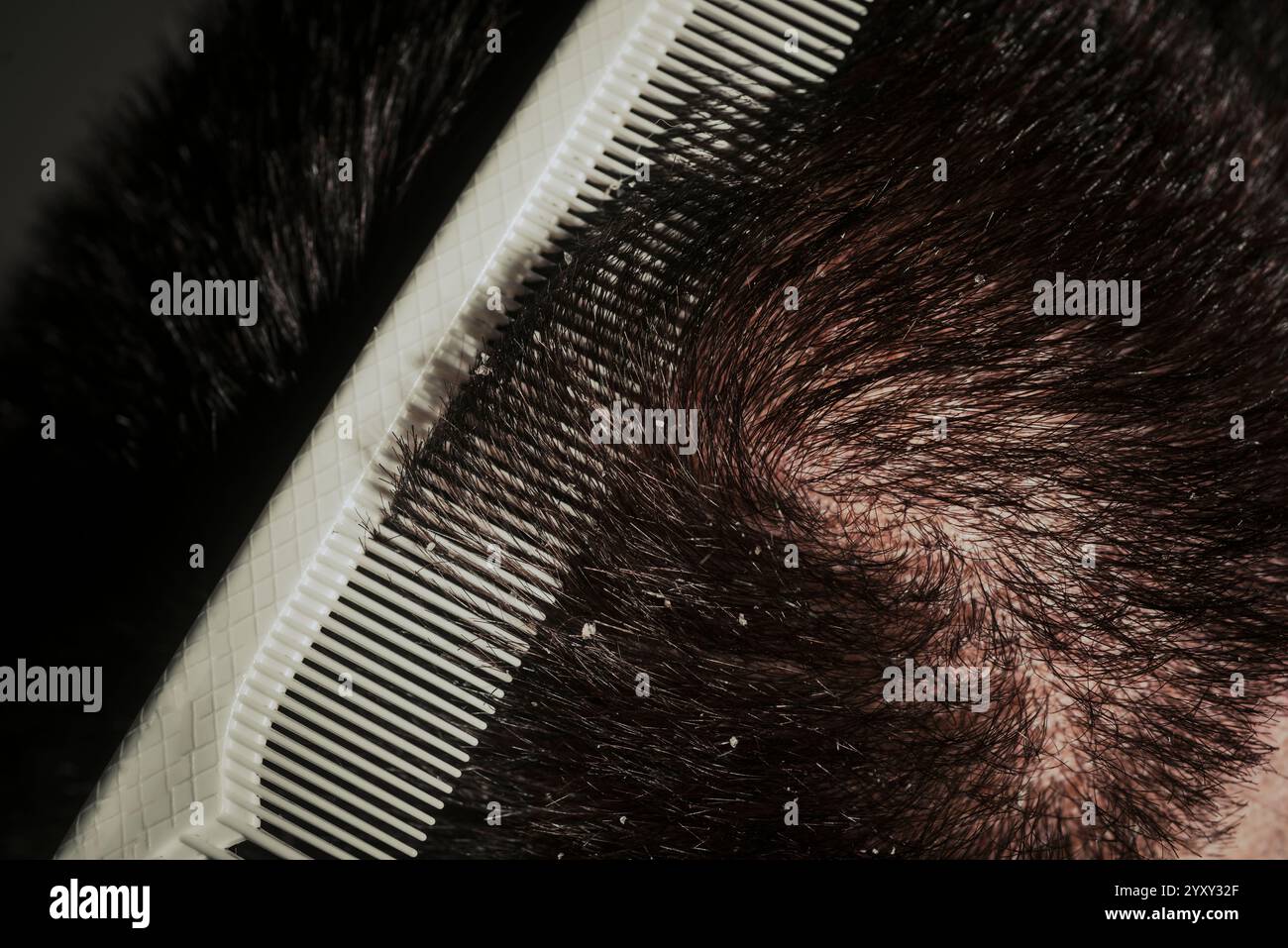 Fatty dandruff hi-res stock photography and images - Alamy
