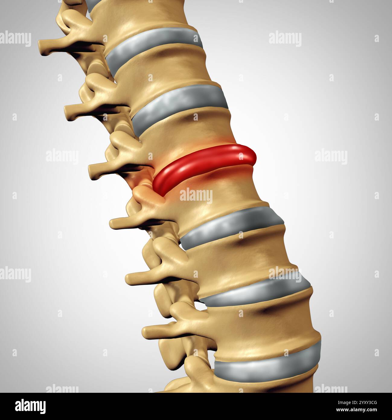 Bulging Disc Disorders back pain concept with on a human skeletal ...