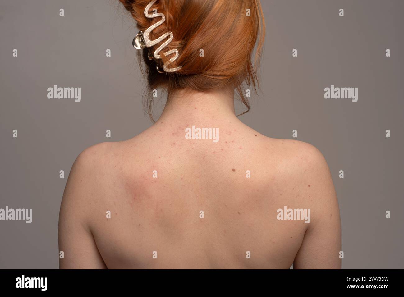 Pimple on back. Skin pimple background. Pimples on back. Acne problem ...